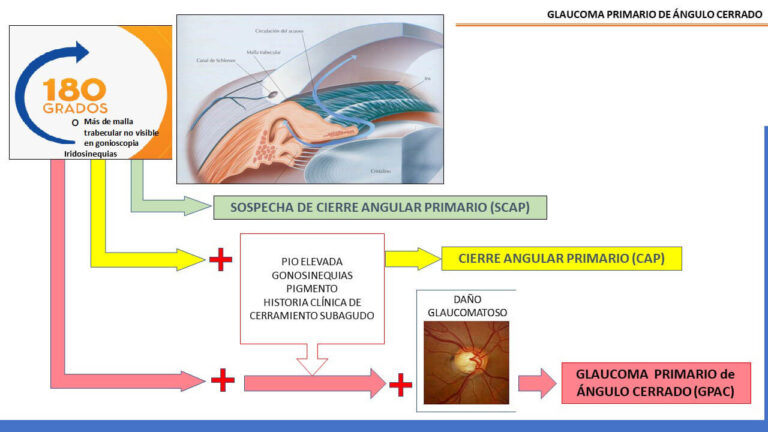 ACTUALIZACIÓN DE GLAUCOMA EN ÁNGULO CERRADO - Oftalmologo Quito - Dr ...
