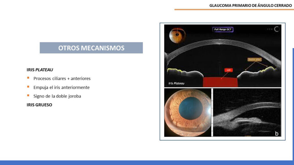ACTUALIZACIÓN DE GLAUCOMA EN ÁNGULO CERRADO - Oftalmologo Quito - Dr ...
