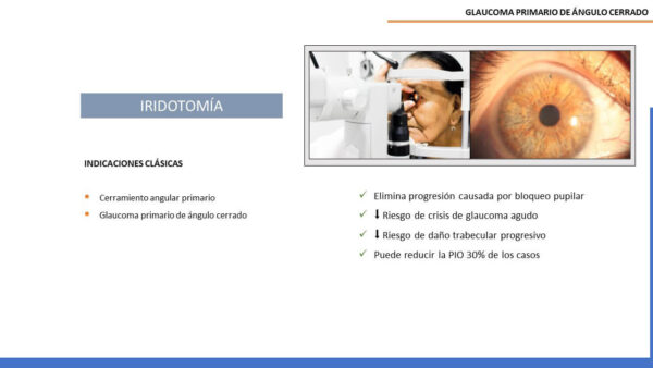 ACTUALIZACIÓN DE GLAUCOMA EN ÁNGULO CERRADO - Oftalmologo Quito - Dr ...
