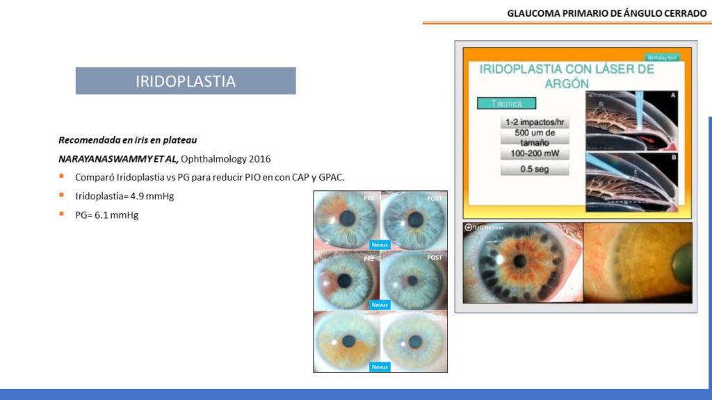ACTUALIZACIÓN DE GLAUCOMA EN ÁNGULO CERRADO - Oftalmologo Quito - Dr ...