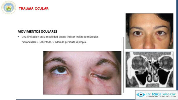 TRAUMA OCULAR - Oftalmologo Quito - Dr. Raúl Salazar Zambrano